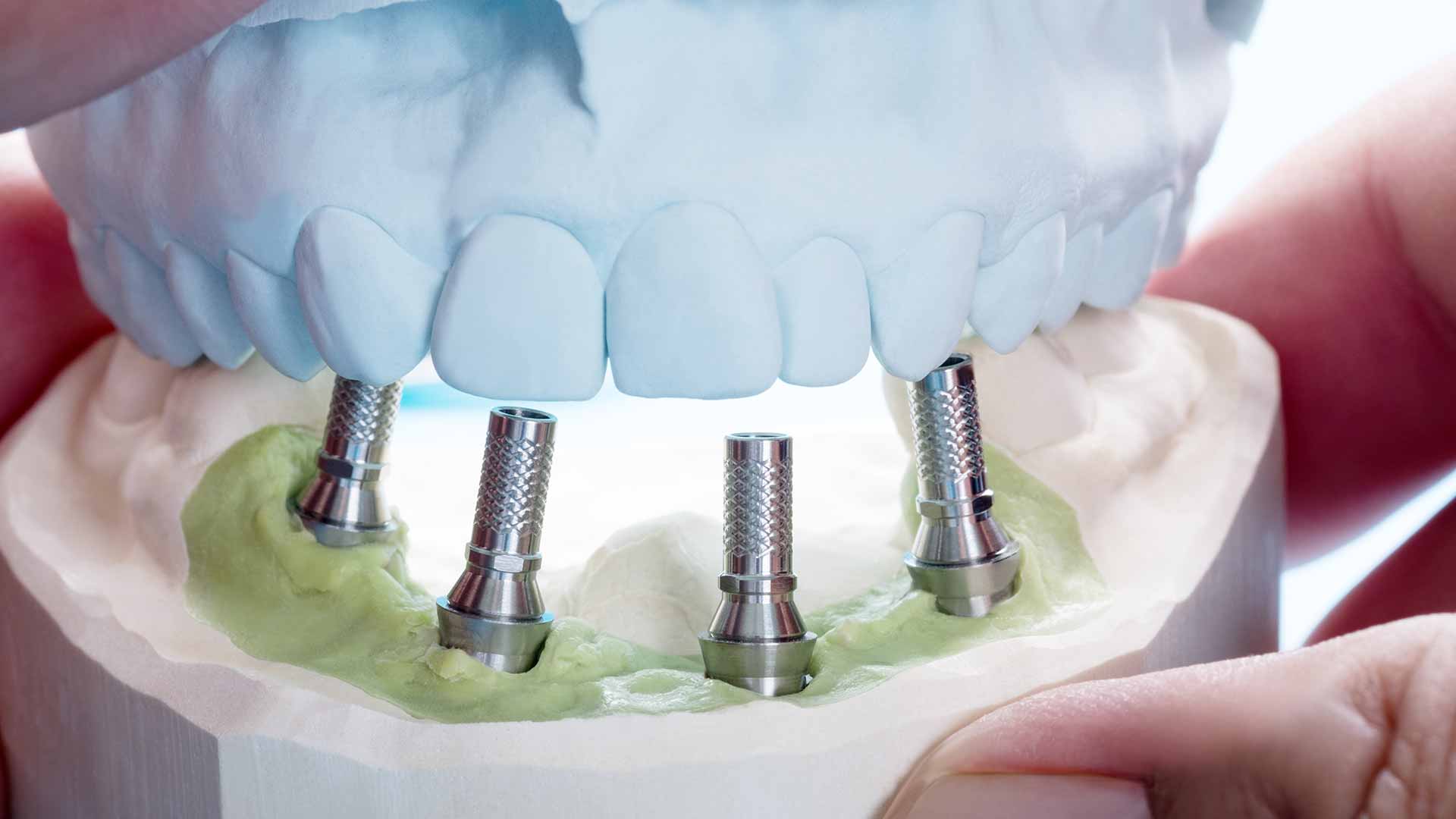 Implant Prostheses in Turkey - Revolutionizing Solutions