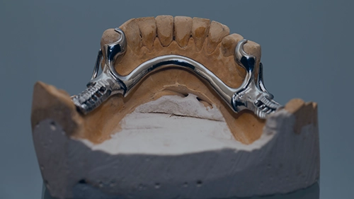 Crown-Bridge Prosthesis - Metal, Ceramic and Zirconium