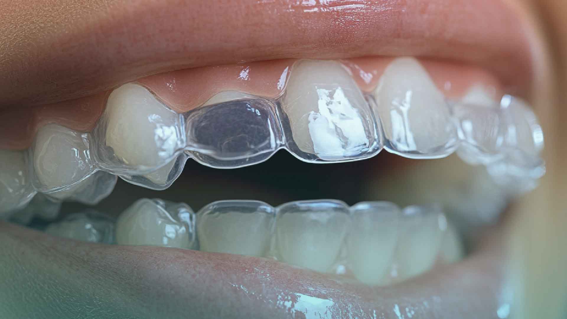 Clear Aligners In Turkey Invisalign Treatment Aliadent