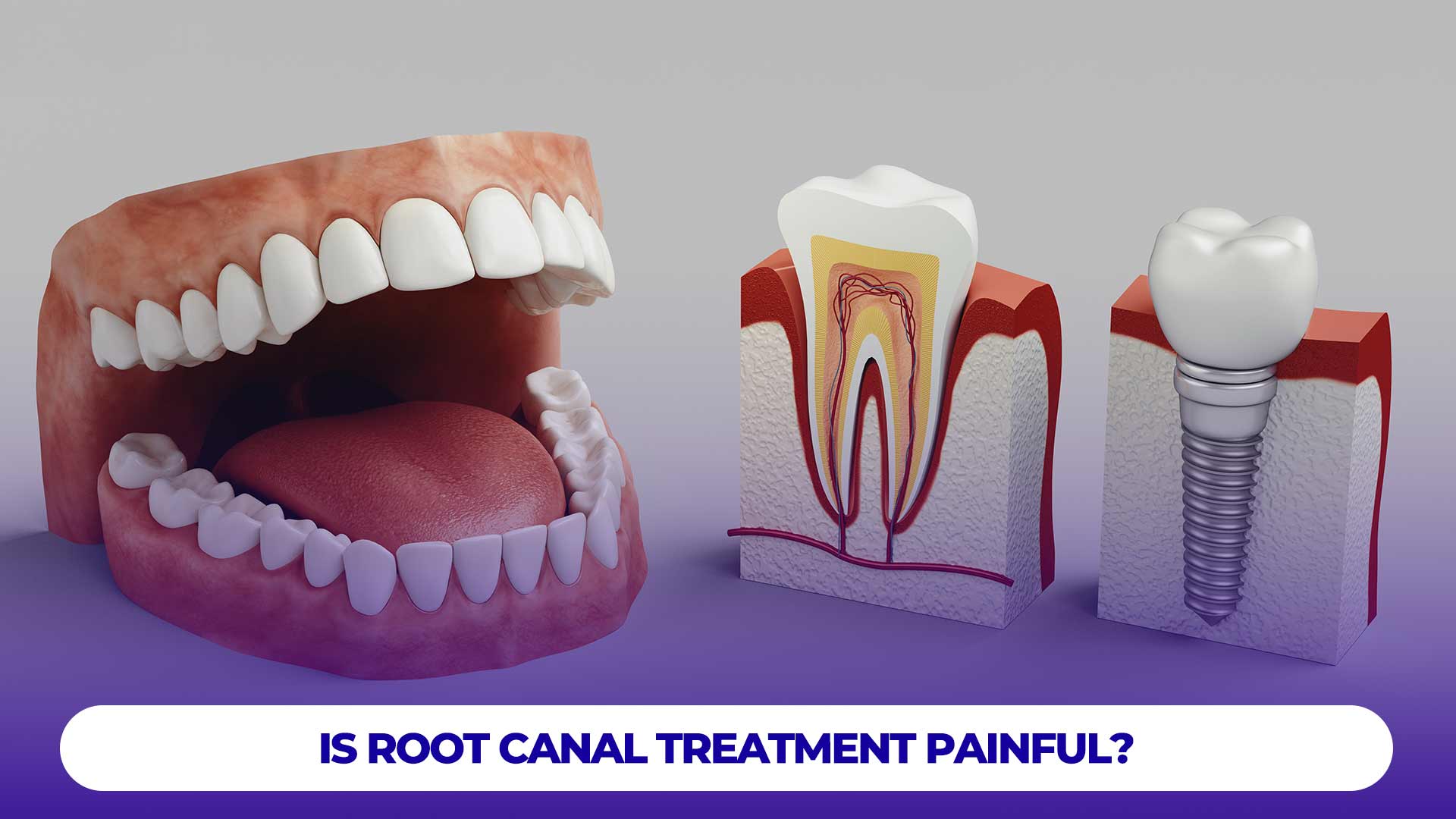 Is Root Canal Treatment Painful? - Discover More - Aliadent