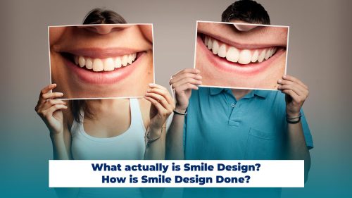 What actually is Smile Design? How is Smile Design Done?